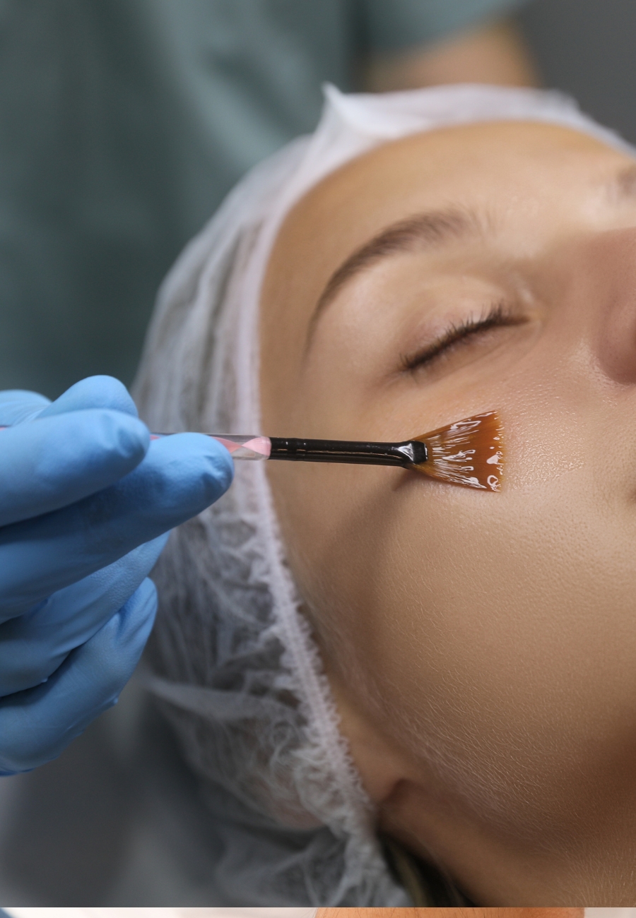 Peeling - Clinica LM Estetica
